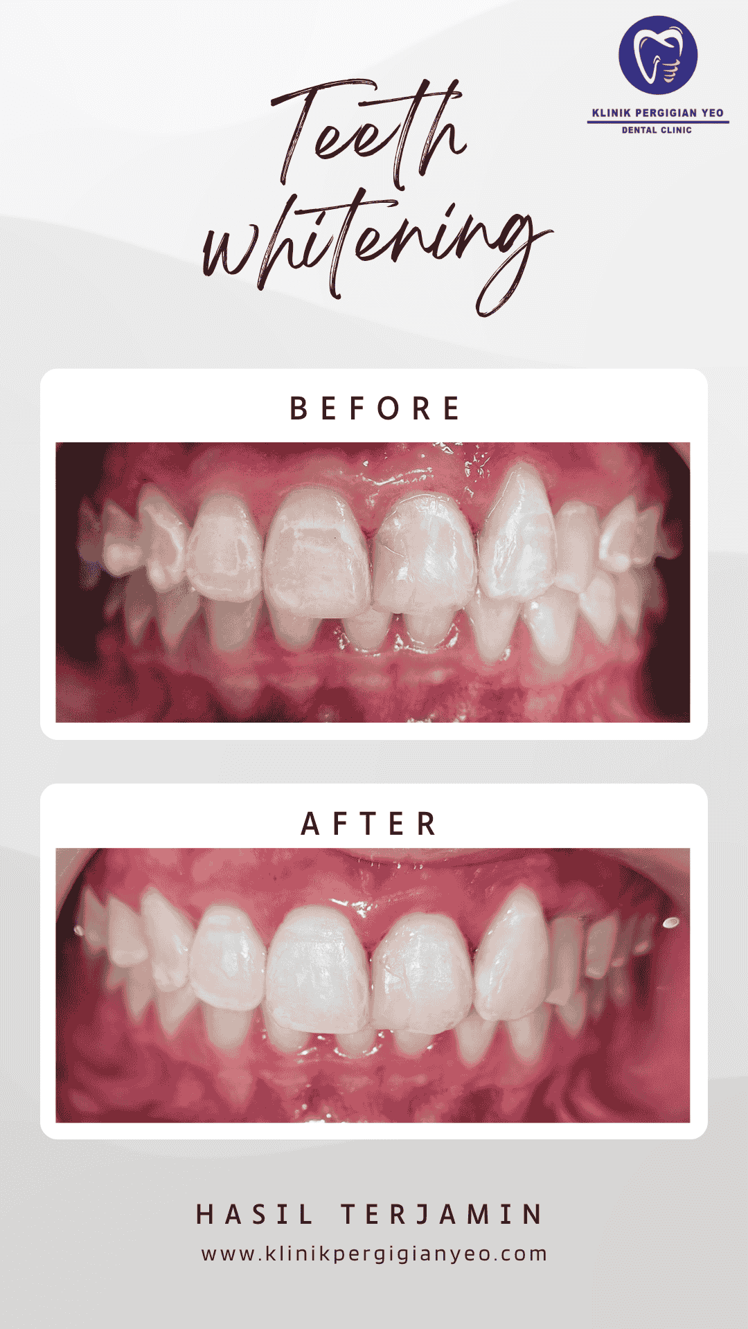 Before & After - Klinik Pergigian YEO